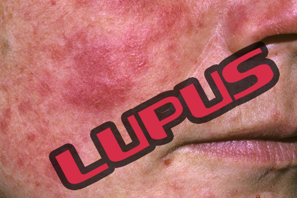 Lupus - Clinica Hispana Woodforest