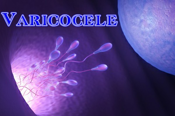 Varicocele - Clinica Hispana Woodforest